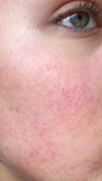 Makeup Allergic Reaction!! | Beautylish