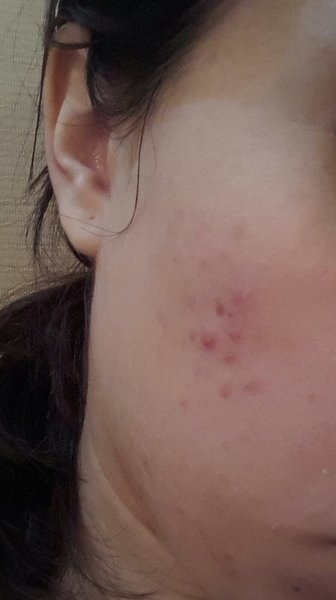 My Face Is Breaking Out?? | Beautylish