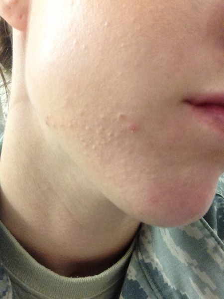 Clogged Pores On Chin That Wont Go Away Beautylish
