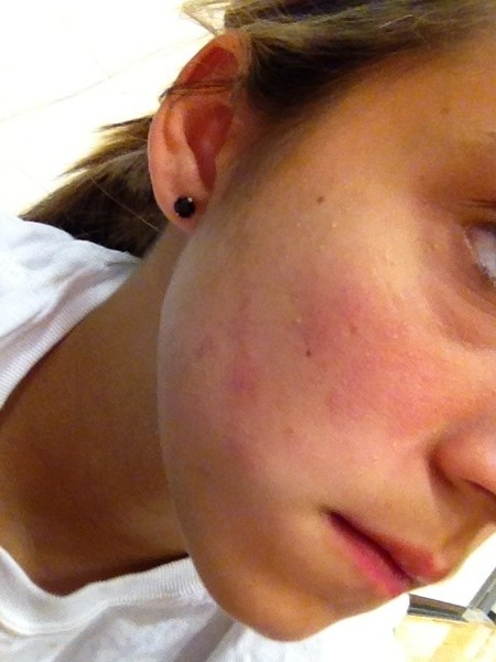 Weird Rash On My Face | Beautylish