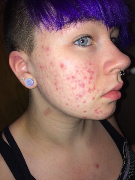 Coverup for acne and really pale skin. | Beautylish