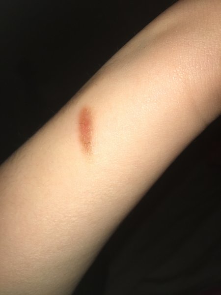 Help!! Burns On Arm And Neck. | Beautylish