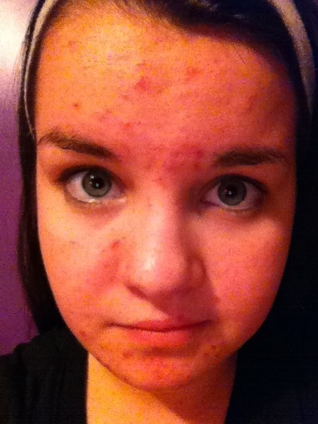 Ugh... Skin Again! | Beautylish