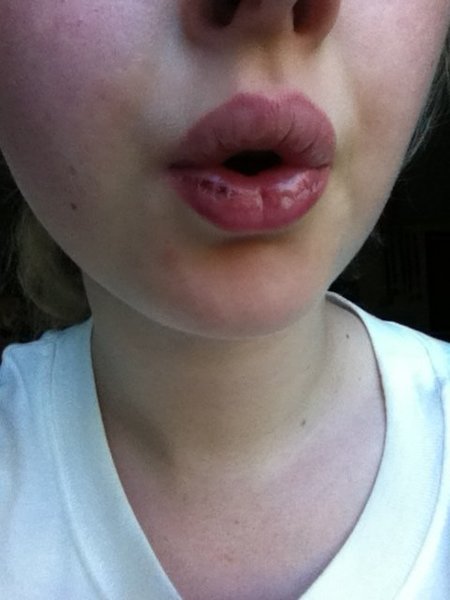 Bleeding dry lips! Help! | Beautylish