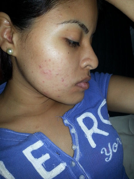 Really bad breakouts! HELP. | Beautylish