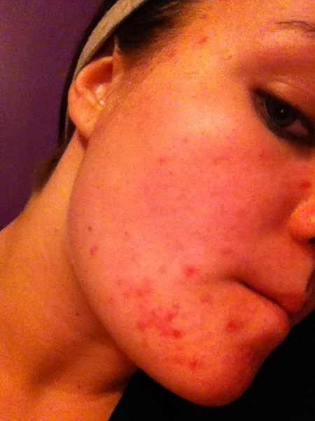 Ugh... Skin Again! | Beautylish