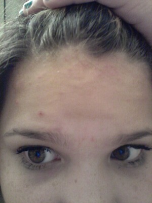 Forehead Pimple Help | Beautylish