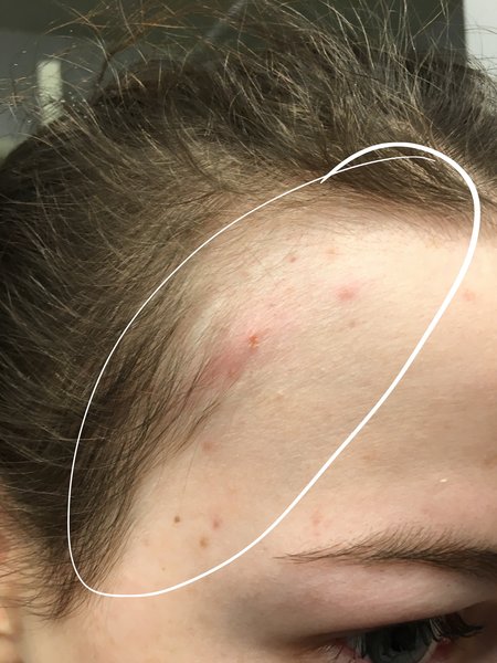 My scalp is getting pimples on it... what should I do? | Beautylish