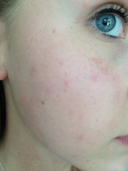 Red Bumps All Over Face!? | Beautylish