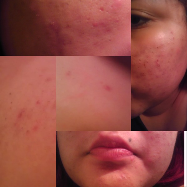 Help With My Acne :C. | Beautylish