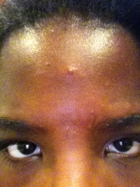 Big pimple on my forehead right in the middle. | Beautylish