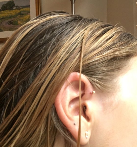 Bump on Forward Helix Piercing - Normal bump or is it rejecting ...