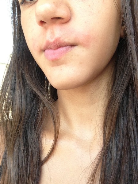 HELP moustache waxing burn!! | Beautylish