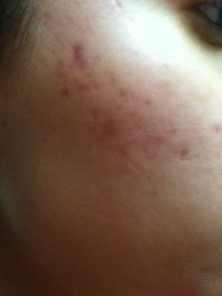 Red blemishes :( | Beautylish