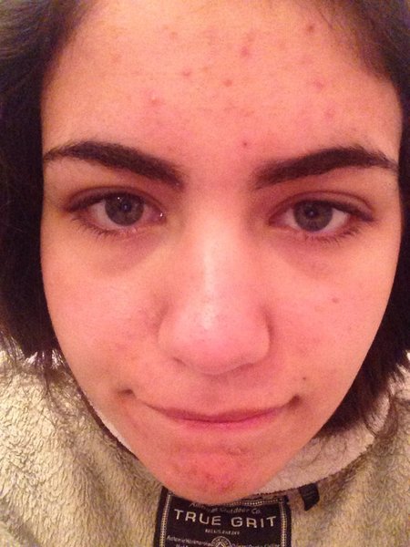 Pimples by my period?! How does this work! PLEASE HELP. | Beautylish