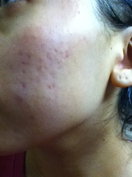 Red blemishes :( | Beautylish