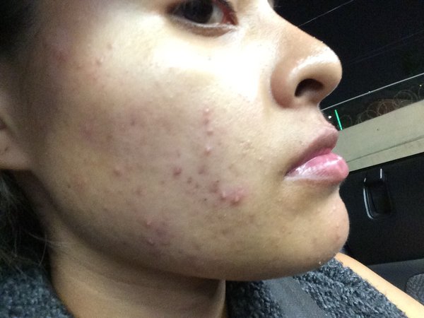 I'm breaking out horribly and I don't know why!? | Beautylish